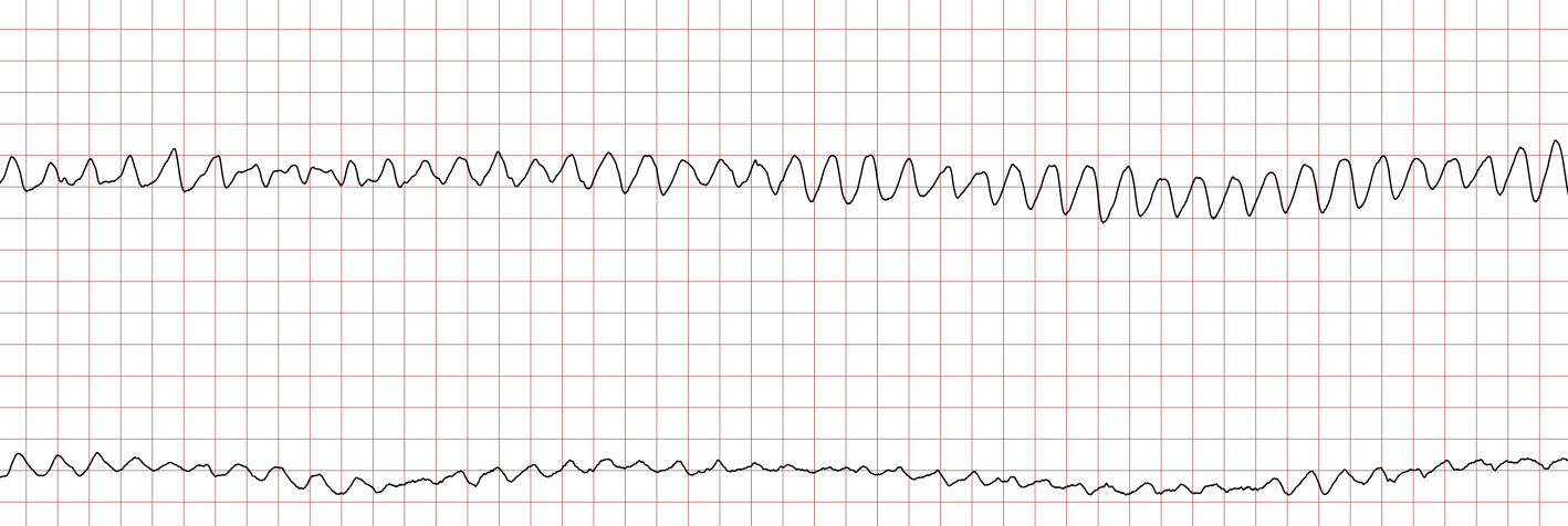 Sudden cardiac arrest: Case 1