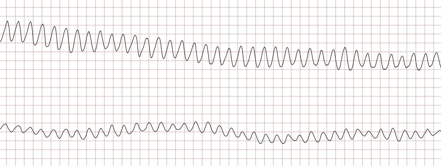 Sudden cardiac arrest: Case 1