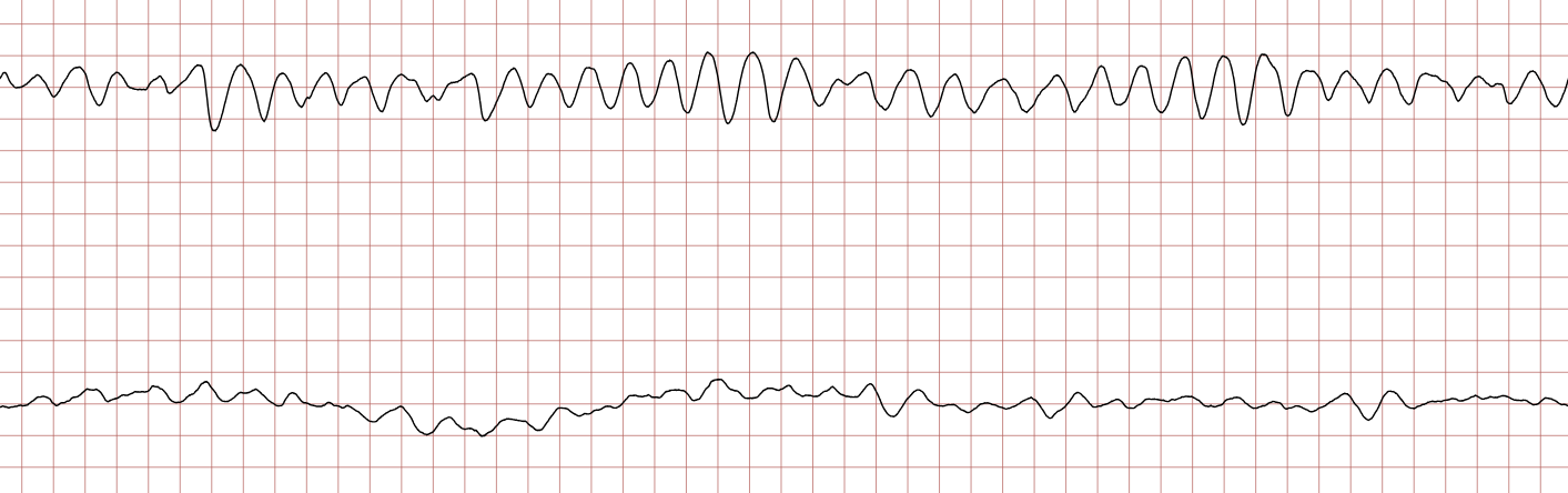 Sudden cardiac arrest (ventricular fibrillation, ventricular ...