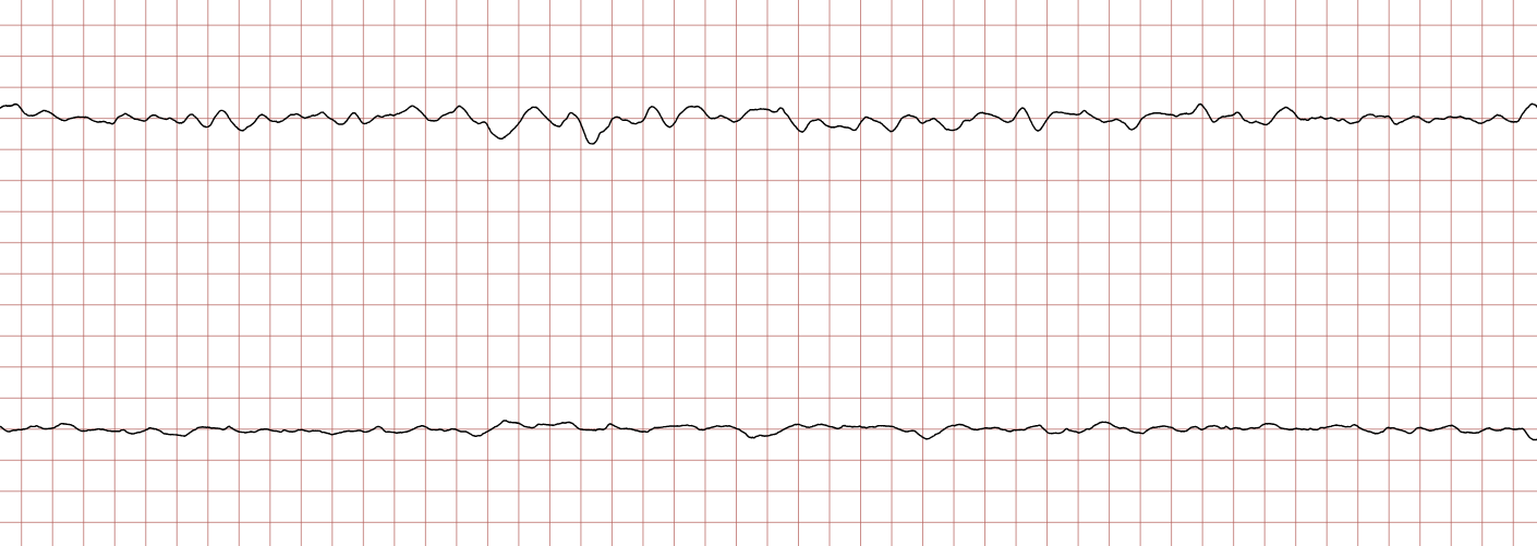 Sudden cardiac arrest: Case 1