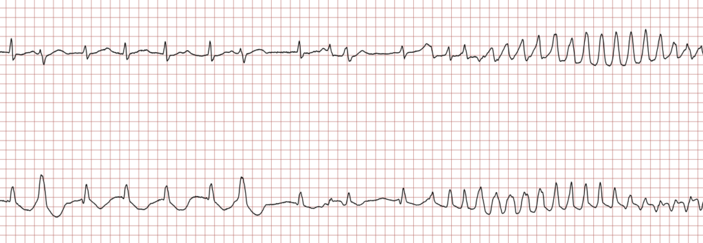 Sudden cardiac arrest: Case 7