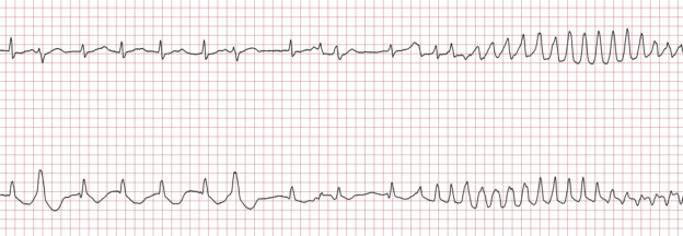 ventricular-tachycardia-fibrillation-flutter-monomorphic-polymorphic-1 ...