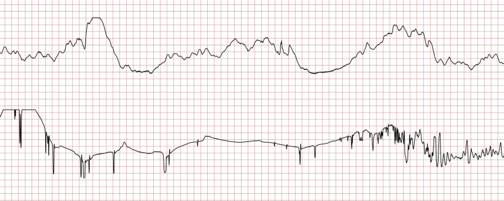 ventricular-tachycardia-fibrillation-flutter-monomorphic-polymorphic-1 ...