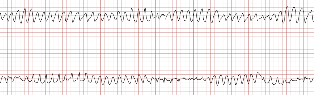 ventricular-tachycardia-fibrillation-flutter-monomorphic-polymorphic-2 ...