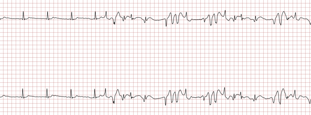 ventricular-tachycardia-fibrillation-flutter-monomorphic-polymorphic-2 ...