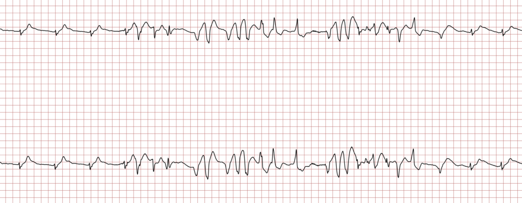 ventricular-tachycardia-fibrillation-flutter-monomorphic-polymorphic-3 ...