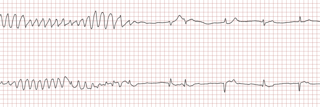 ventricular-tachycardia-fibrillation-flutter-monomorphic-polymorphic-3 ...