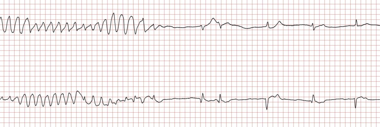 ventricular-tachycardia-fibrillation-flutter-monomorphic-polymorphic-3 ...
