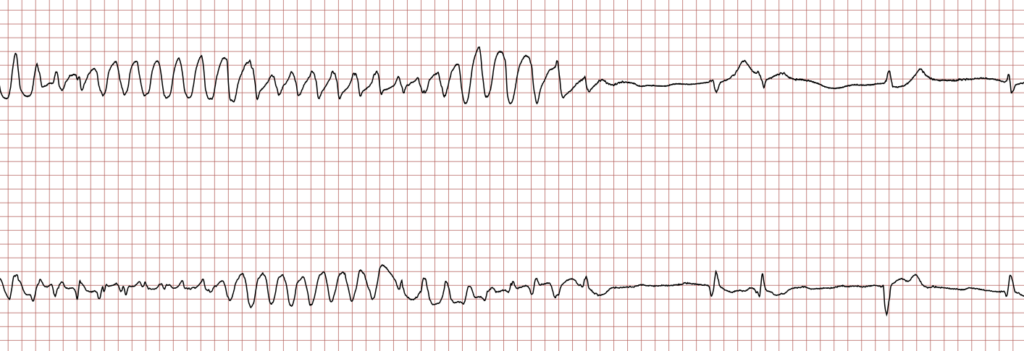ventricular-tachycardia-fibrillation-flutter-monomorphic-polymorphic-4 ...