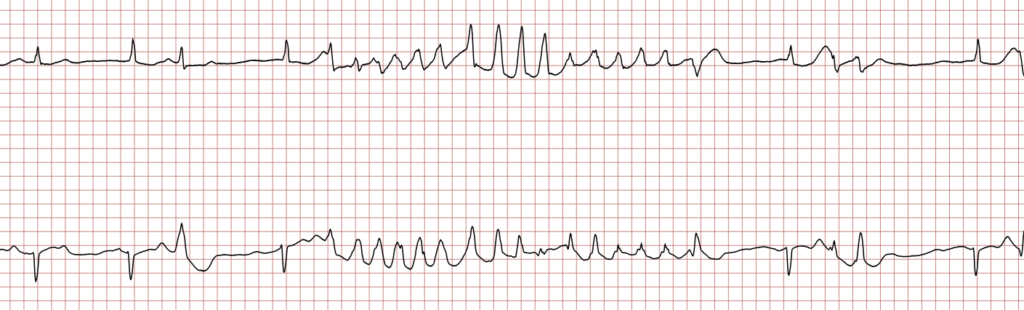 ventricular-tachycardia-fibrillation-flutter-monomorphic-polymorphic-5 ...