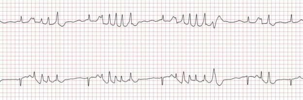 ventricular-tachycardia-fibrillation-flutter-monomorphic-polymorphic-6 ...