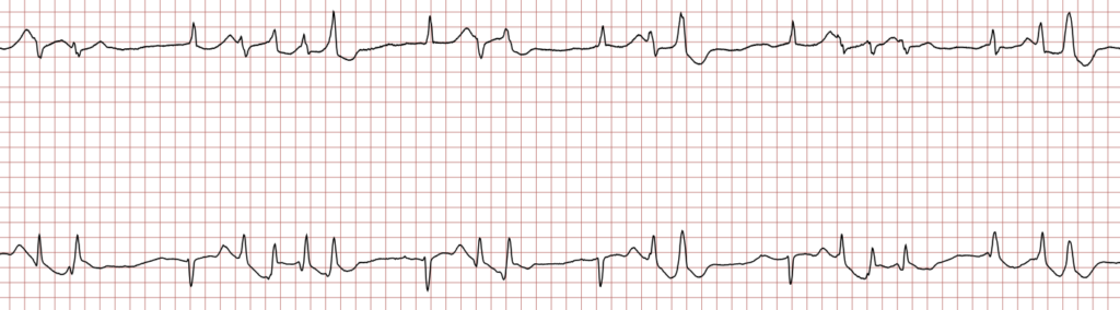 ventricular-tachycardia-fibrillation-flutter-monomorphic-polymorphic-7 ...