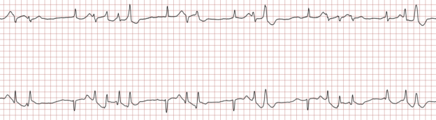 ventricular-tachycardia-fibrillation-flutter-monomorphic-polymorphic-7 ...