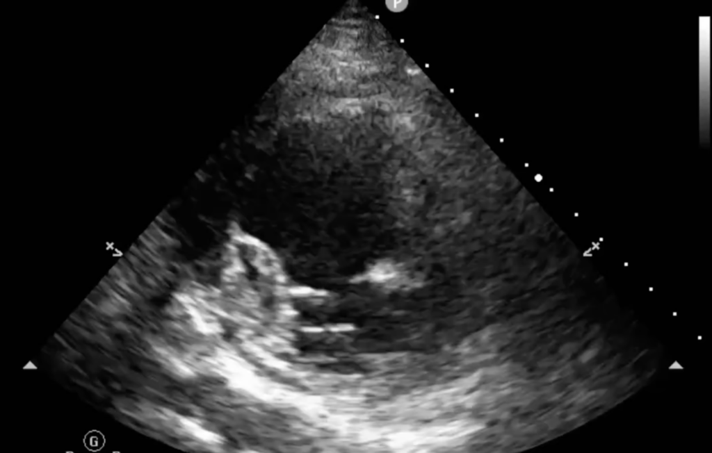 Left ventricular thrombus due to anteroseptal myocardial infarction ...